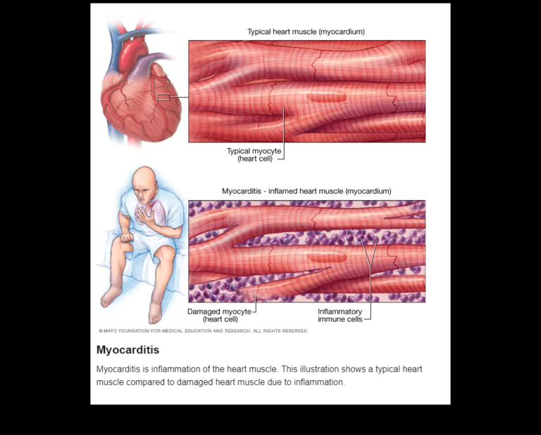 Myocarditis - Emergency Room
